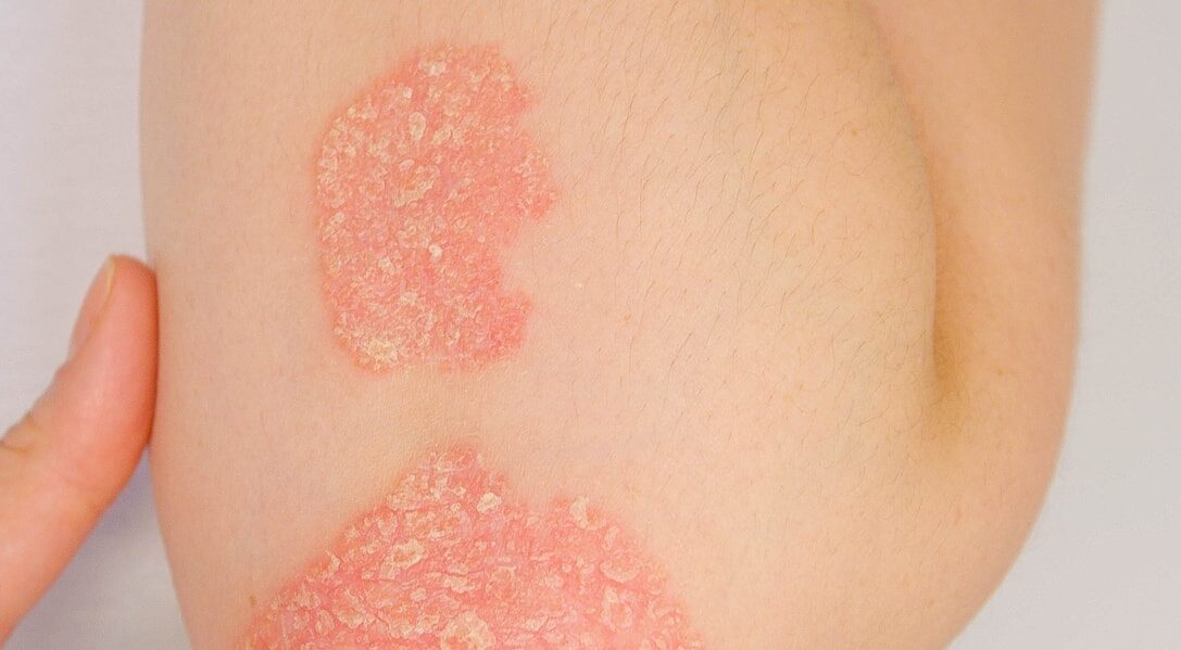 Psoriasis Treatment in Southlake, TX | Compassion Dermatology